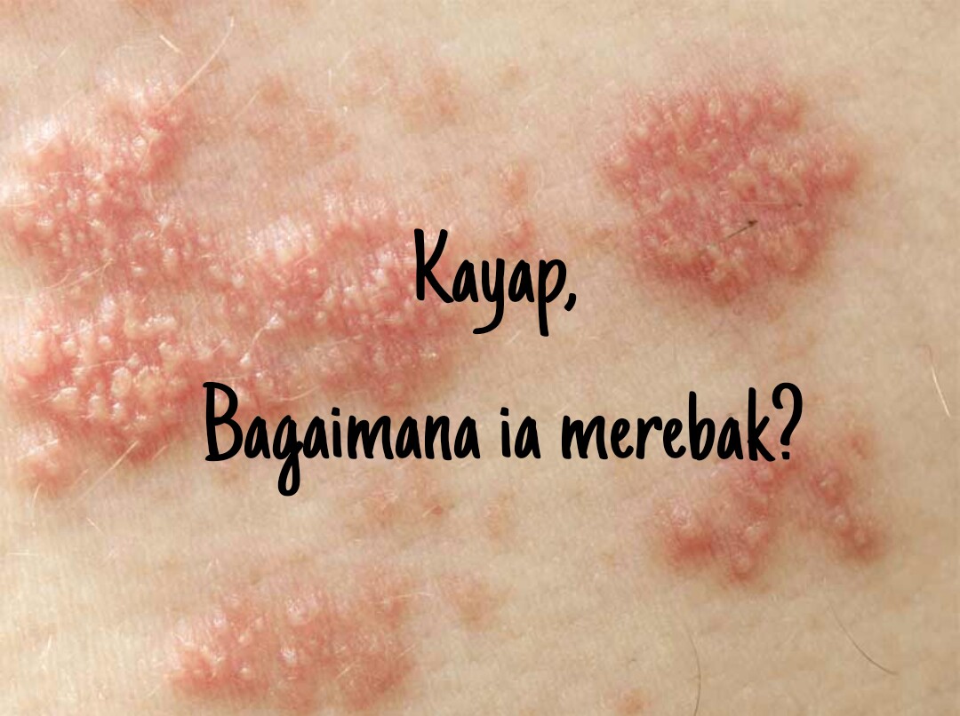 VITAMIN KU SIHAT: Kayap : Tanda dan Cara Mengatasinya