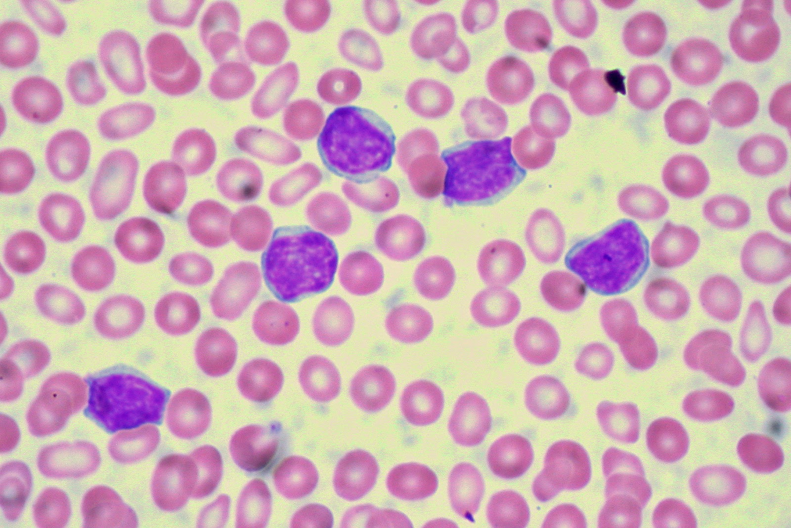 Gejala Penyakit Leukimia Serta Cara Mencegahnya | Penyebab Penyakit ...