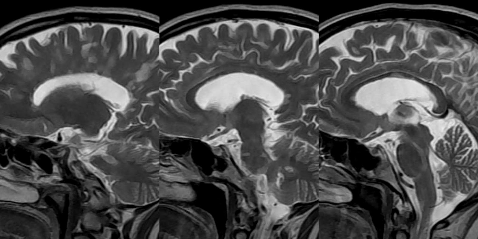 Dr Balaji Anvekar Frcr Multiple Sclerosis Axial Vs Sagittal T2