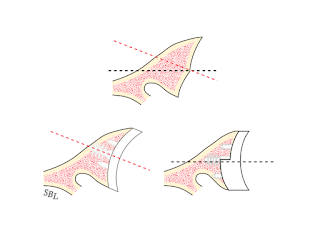 Shoulder Arthritis / Joint Replacement : Posterior augmented glenoid ...