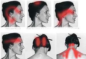 Dores Na Nuca |TUTORIAL SAÚDE