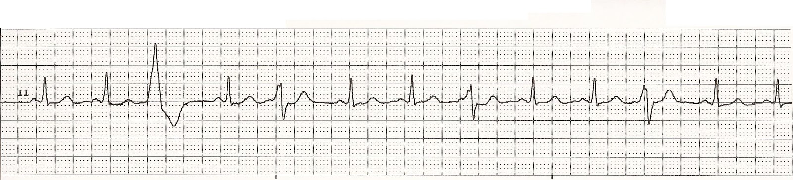 ECG Rhythm Strips 74