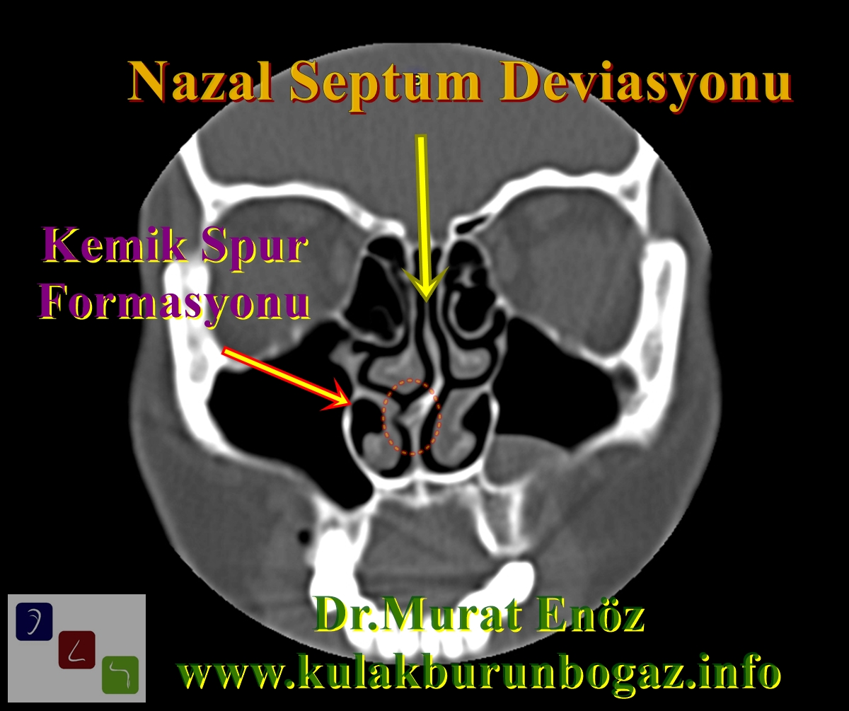 Ossified Overhang (Osteophyte) In The Nose That Can Cause Atypical ...