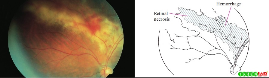 [Emergency] Atlas of Cytomegalovirus Retinitis | Free Medical Atlas