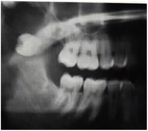 Dentistry and Medicine: Surgical management of Unerupted and Impacted teeth