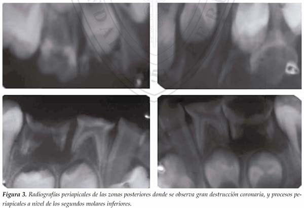 INTERPRETACION DE CARIES RADIOGRAFICAMENTE: La caries radiográficamente