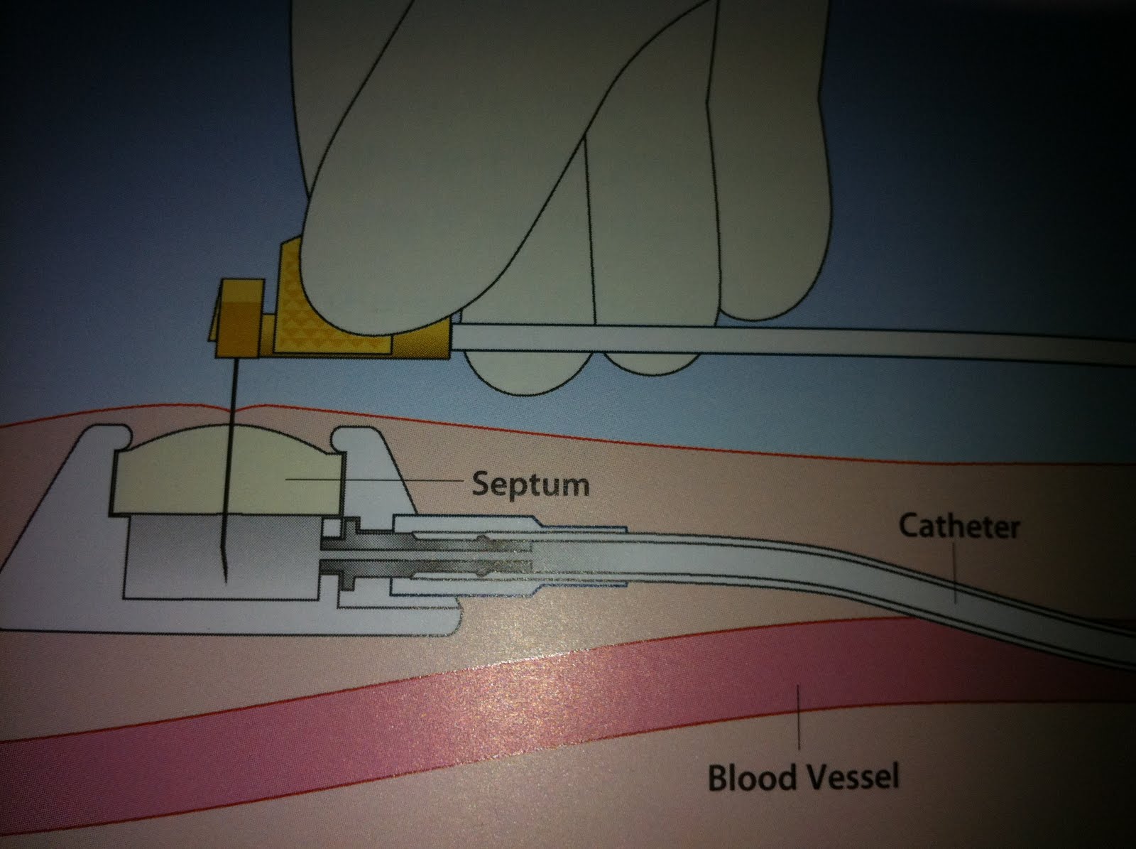 Hmm, Breast Cancer at 32 - Not In My Five Year Plan: Port, Cuddly Toy ...