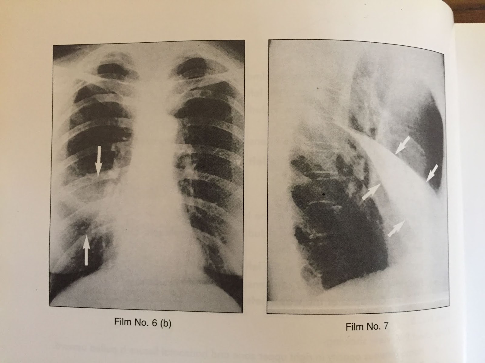 XRAY COLLAPSE OF THE LUNG