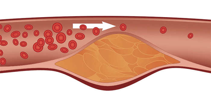 Remedios naturales para limpiar y fortalecer las arterias