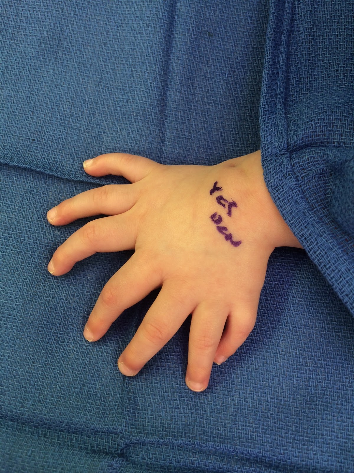 Rebuilding the Mirror Hand | Congenital Hand and Arm Differences ...
