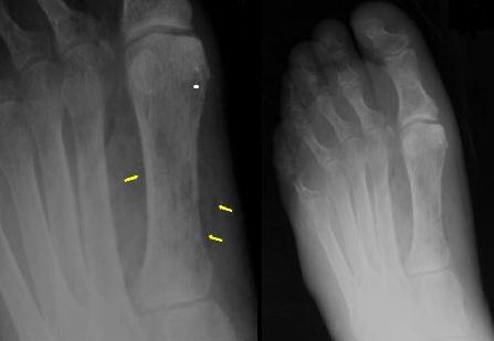 O R T O C R I T I C A: Necrobiosis en el paciente diabetico
