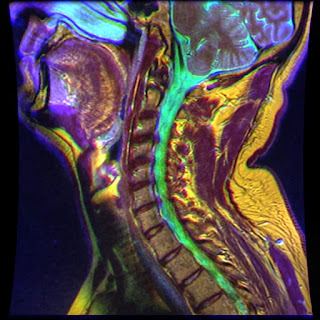 Nevit's blog: Color MRI of the Cervical Spine