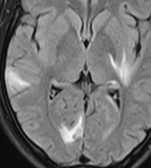 RADIODIAGNOSIS - IMAGE COLLECTION: INTRAOCULAR CYSTICERCOSIS