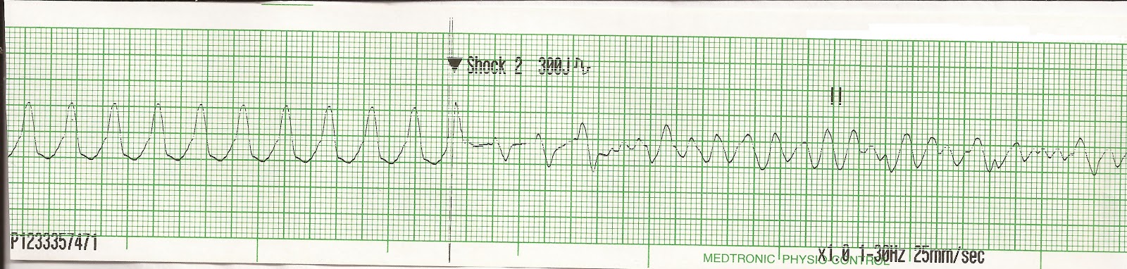 Electrical Interventions