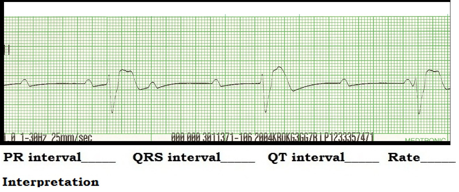 ECG Rhythm Strip Quiz 91: Interval measurements