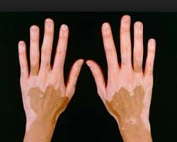 .: Cara Atasi Sopak atau Vitiligo Dengan Semulajadi