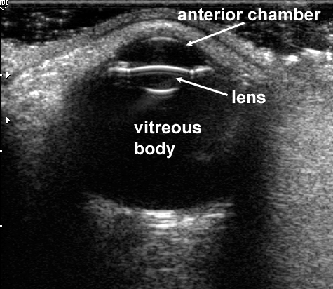 Ultrasound image of a normal eye with lens - Radiology Imaging