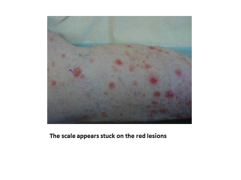 Consultations in Dermatology: Pityriasis Lichenoides PLEVA