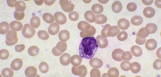 FICHERO DE HEMATOLOGÍA: ANORMALIDADES LEUCOCITARIAS. Cambios en el ...