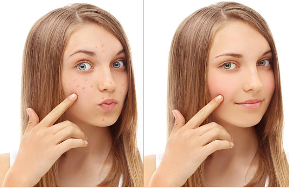 How to Get Rid of Pimples with Home Remedies
