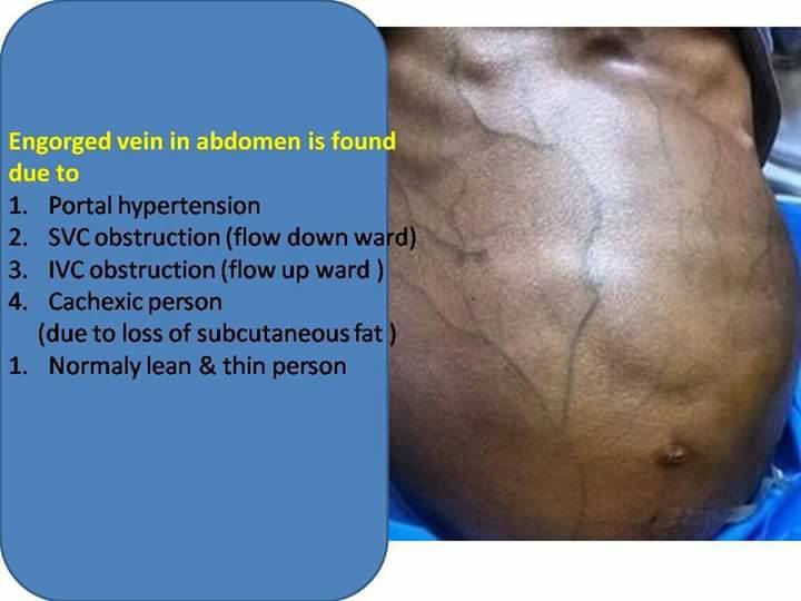 medicalonline: Examination of the patient with ascites