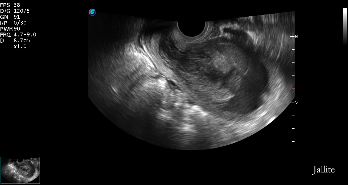 Hematoma Intrauterino