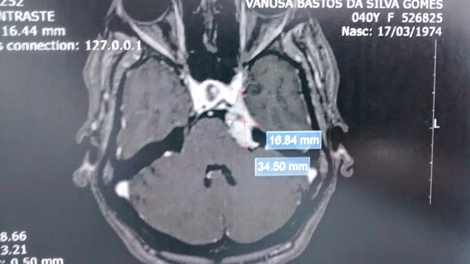 RESIDÊNCIA DE CLÍNICA MÉDICA HGCA: CASO CLINICO DE DOR FACIAL