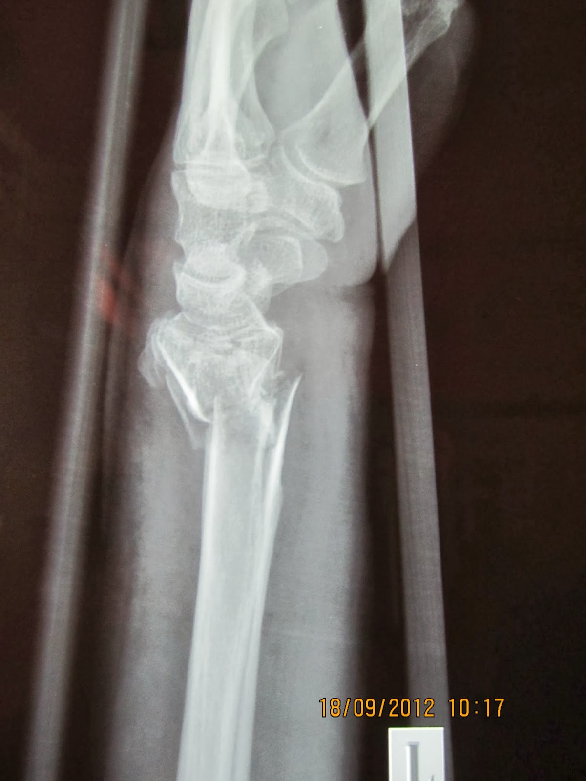 BẢO TỒN CƠ XƯƠNG KHỚP: GÃY POUTEAU.COLLES