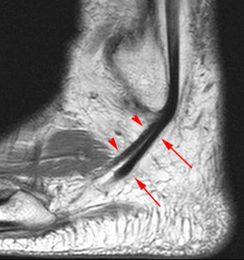 MRI Musculo-Skeletal Section: Normal anatomy of peroneus tendon on MRI