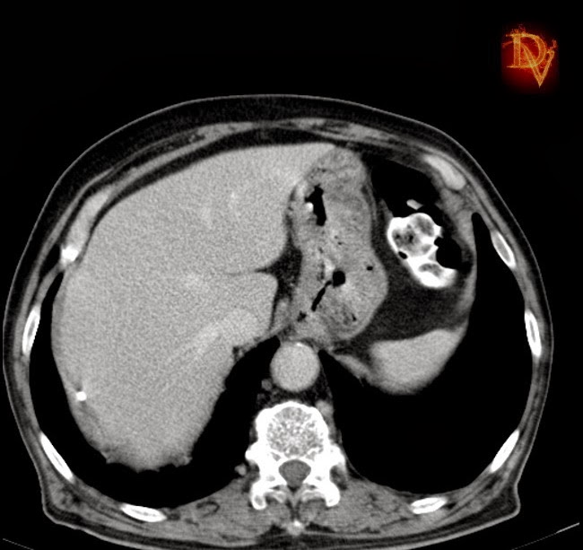 Ultimate Radiology : Duodenal Diverticulum - CT sections