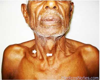 Position of the Trachea and Trail's sign