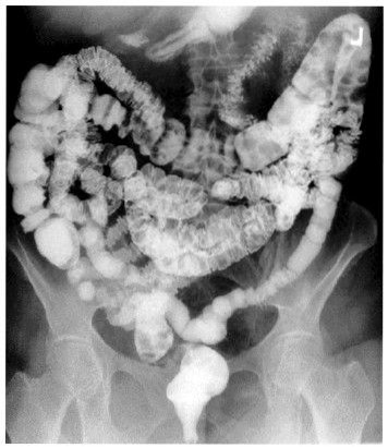 Estudios Contrastados del Sistema Digestivo: Tránsito Del Intestino Delgado