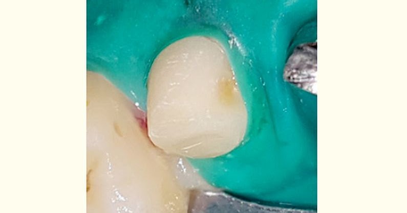 PDF: Immediate Dentin Sealing for Indirect Restoration: Why and How ...