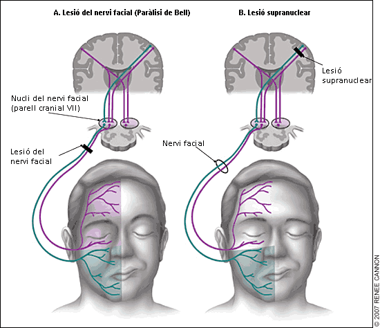 observatorio enfermeria: paralisis facial