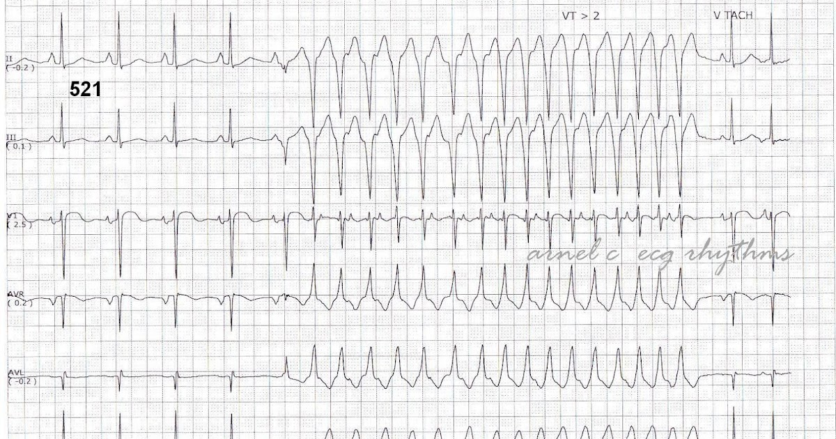 ECG Rhythms: VT or SVT with aberrancy?