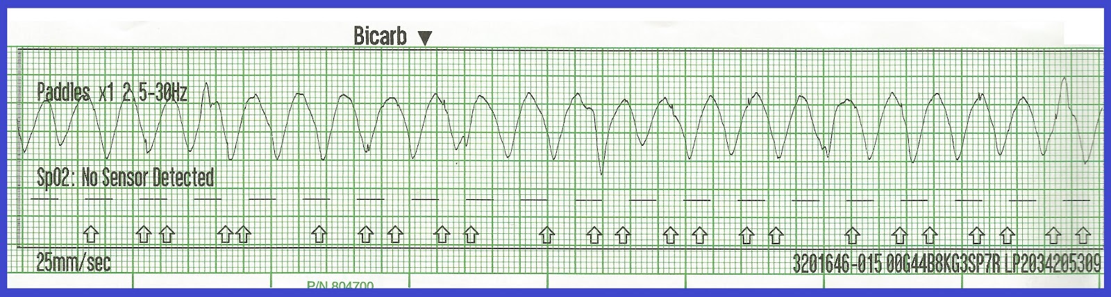 Code Blue: Sudden Cardiac Arrest