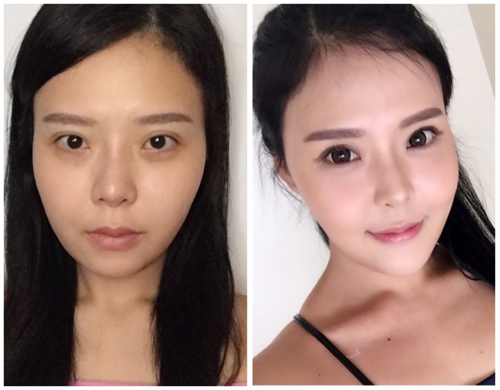 Live A Life You Will Remember : Ellanse Collagen Stimulating Filler 少女针 ...