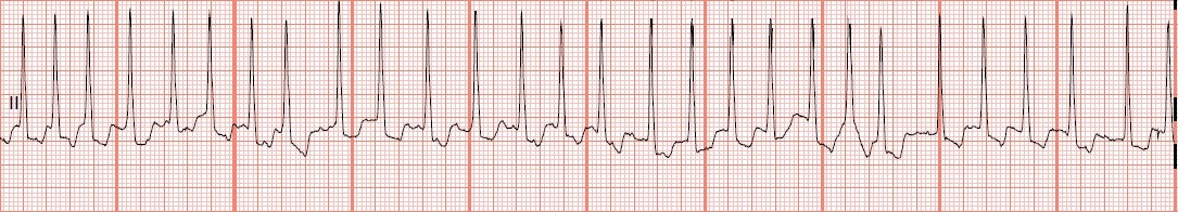 Float Nurse: ECG Rhythm Strip Quiz 71