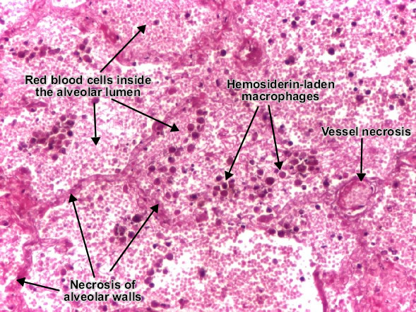 موقع الدكتور أحمد كلحى: صور باثولوجى - Pathology Slides : Pulmonary ...