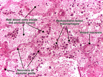 موقع الدكتور أحمد كلحى: صور باثولوجى - Pathology Slides : Pulmonary ...