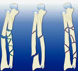 Un médecin du sport vous informe: fractures des 2 os de l'avant bras
