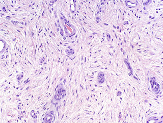 VIRTUAL GRAND ROUNDS IN DERMATOLOGY 2.0: Superficial Acral Fibromyxoma