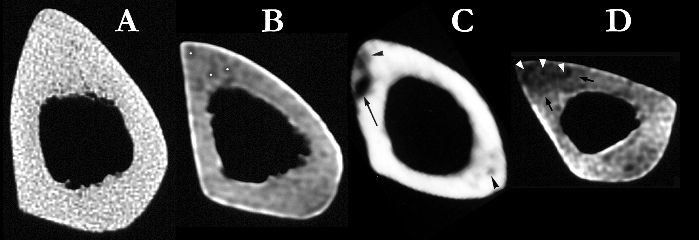 Injury Series: Medial tibial stress syndrome ("shin splints") as a bone ...