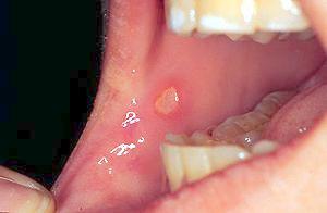 Apthous Ulcers (Mouth Ulcers)