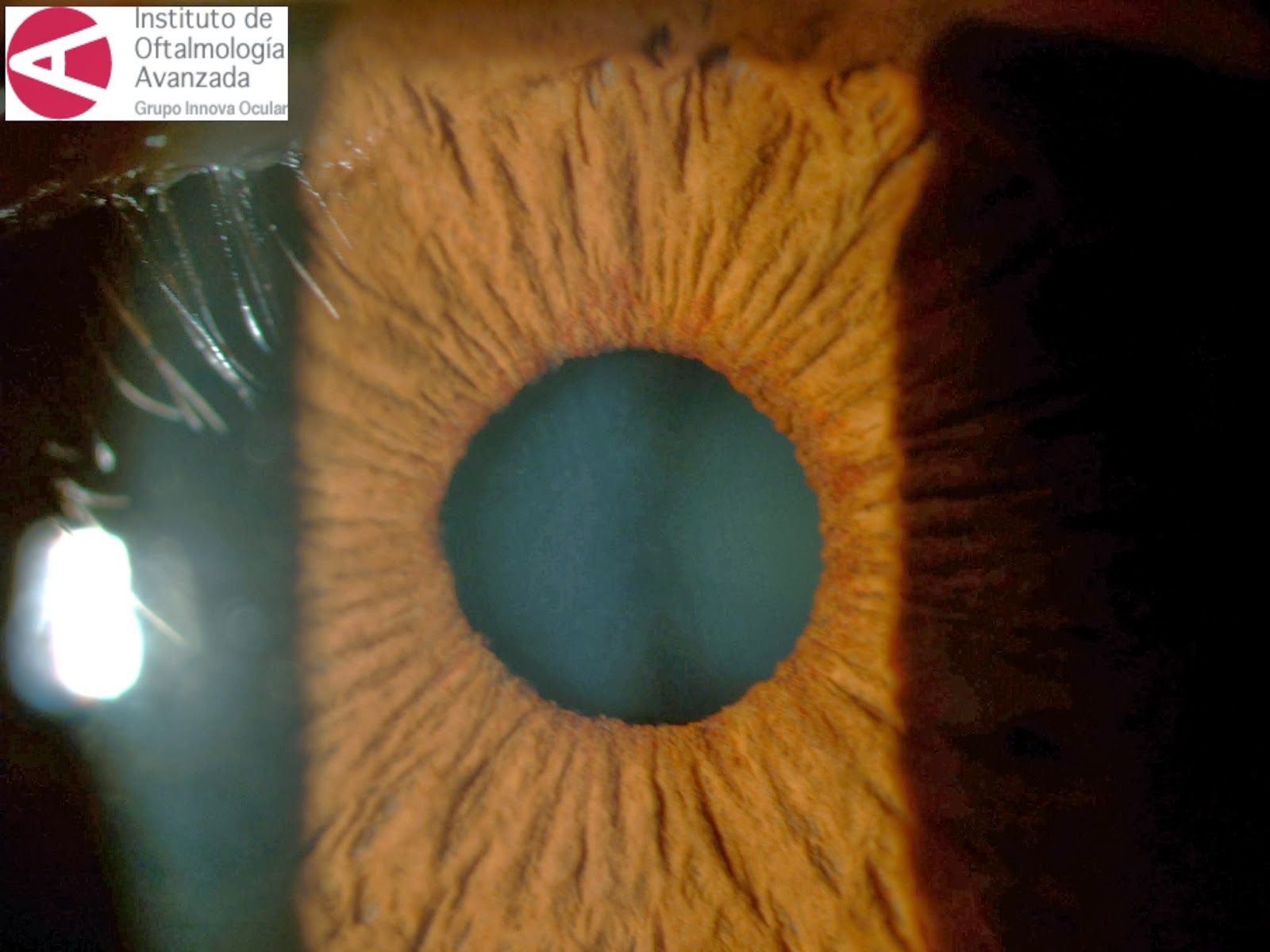 Miranza IOA: RUBEOSIS DE IRIS. PATOLOGÍAS ASOCIADAS