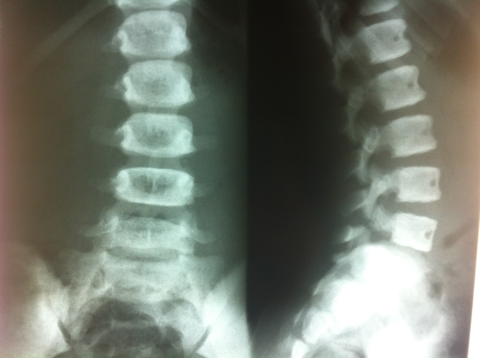 Histologia em Foco : Patologias do Tecido ósseo: Osteopetrose