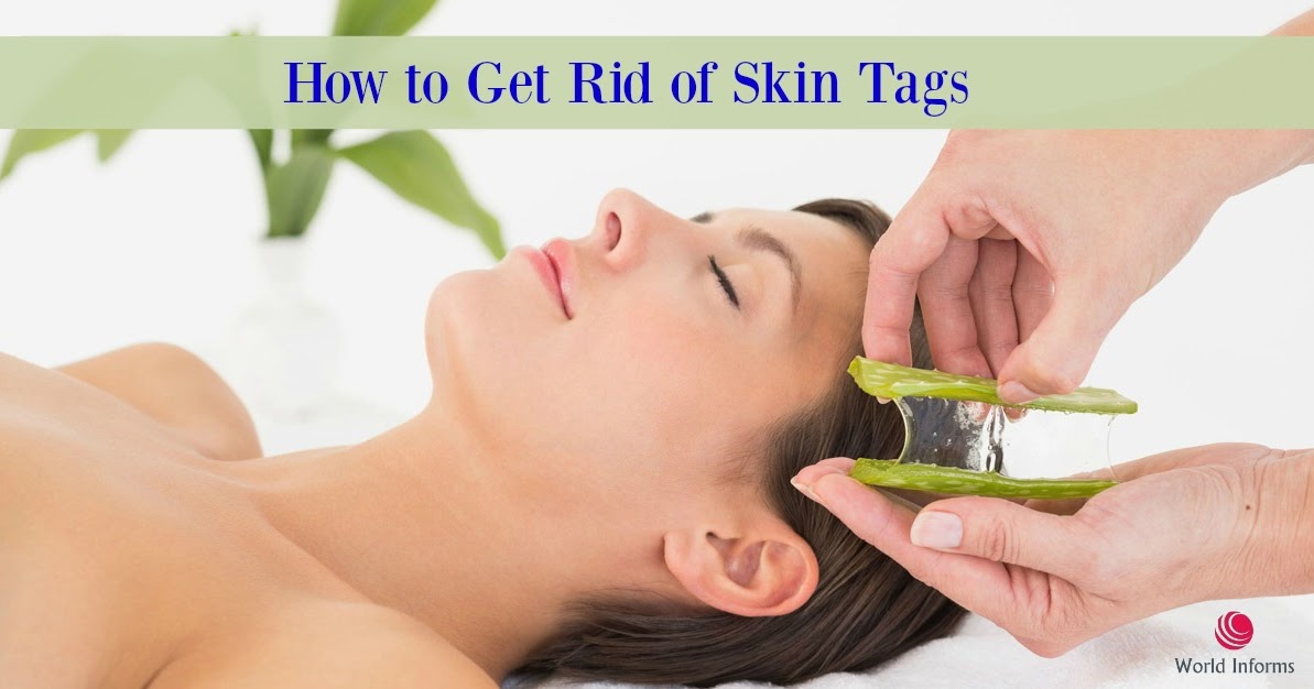 How to Get Rid of Skin Tags - World Informs