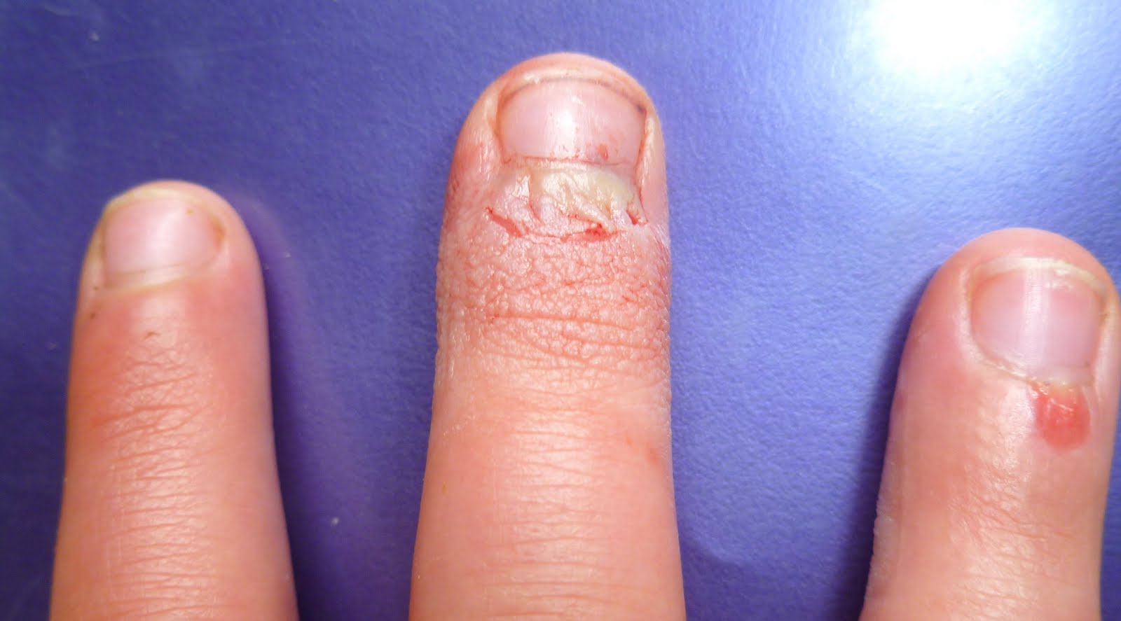 Smashed Middle Finger