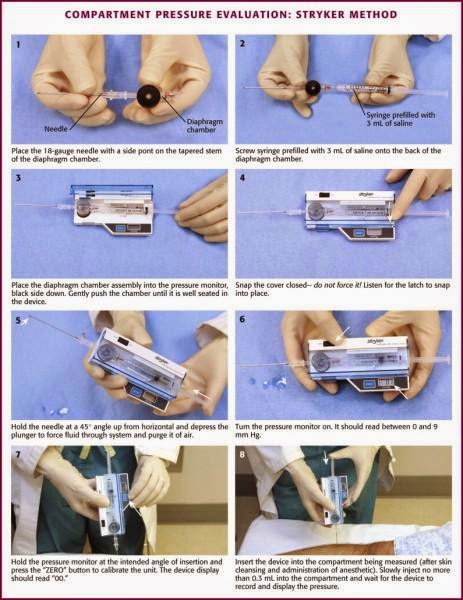 Procedures Club: Compartment Pressure Measurement - "Stryker" It!