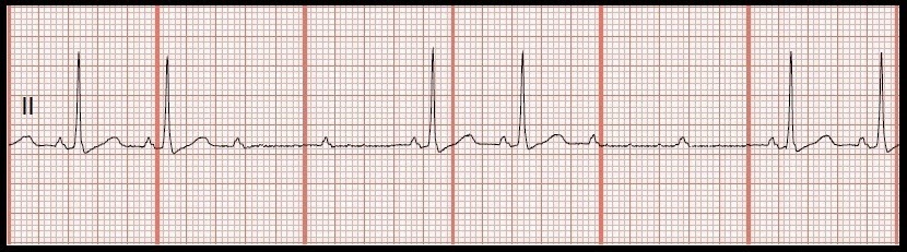 Various 2nd Degree Heart Block Type II